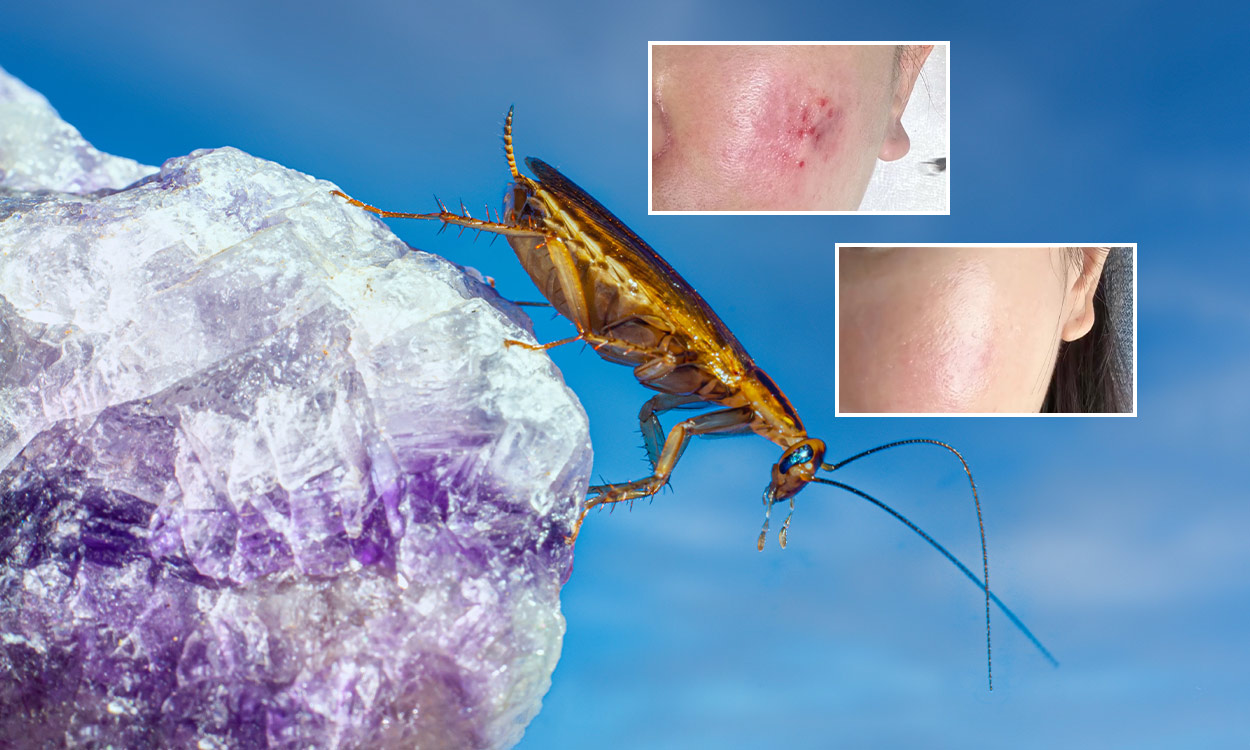 Influencer claims putting cockroach juice on her face cur...